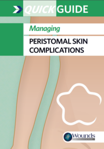 Managing peristomal skin complications Quick Guide – Wounds Middle East